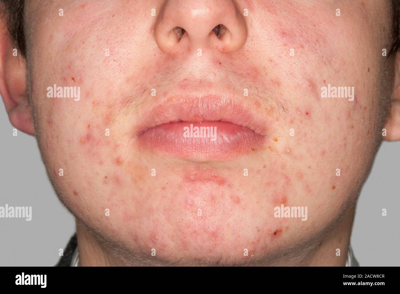 Acne vulgaris on the face. Close-up of pustules of acne on the face of ...
