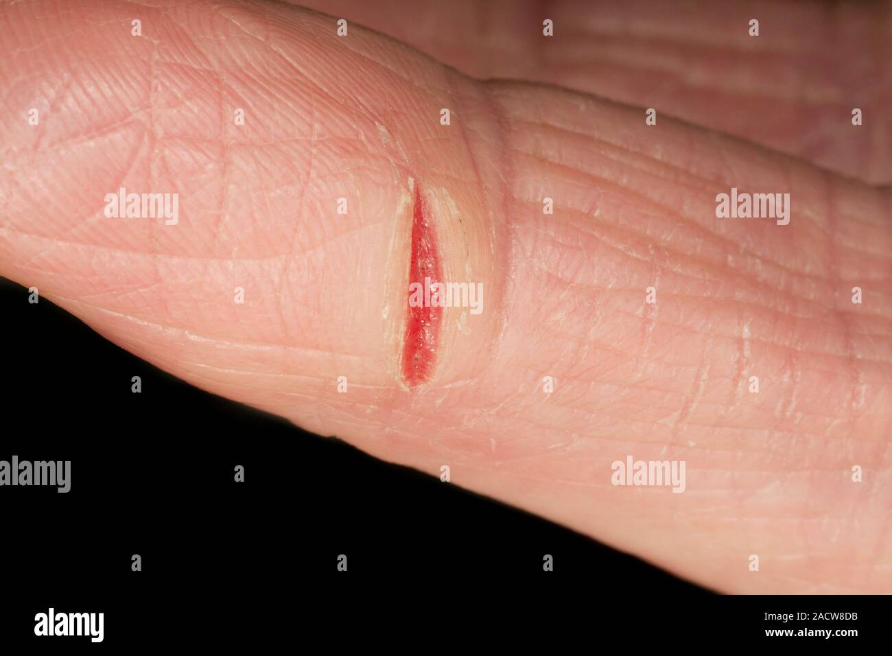 Eczema of the hand. Close-up of a fissure in the finger of a 45-year ...