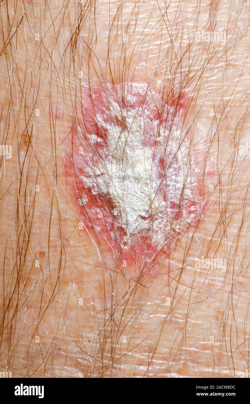 Eczema of the leg. Close-up of a lesion on the sin of a 59-year-old ...
