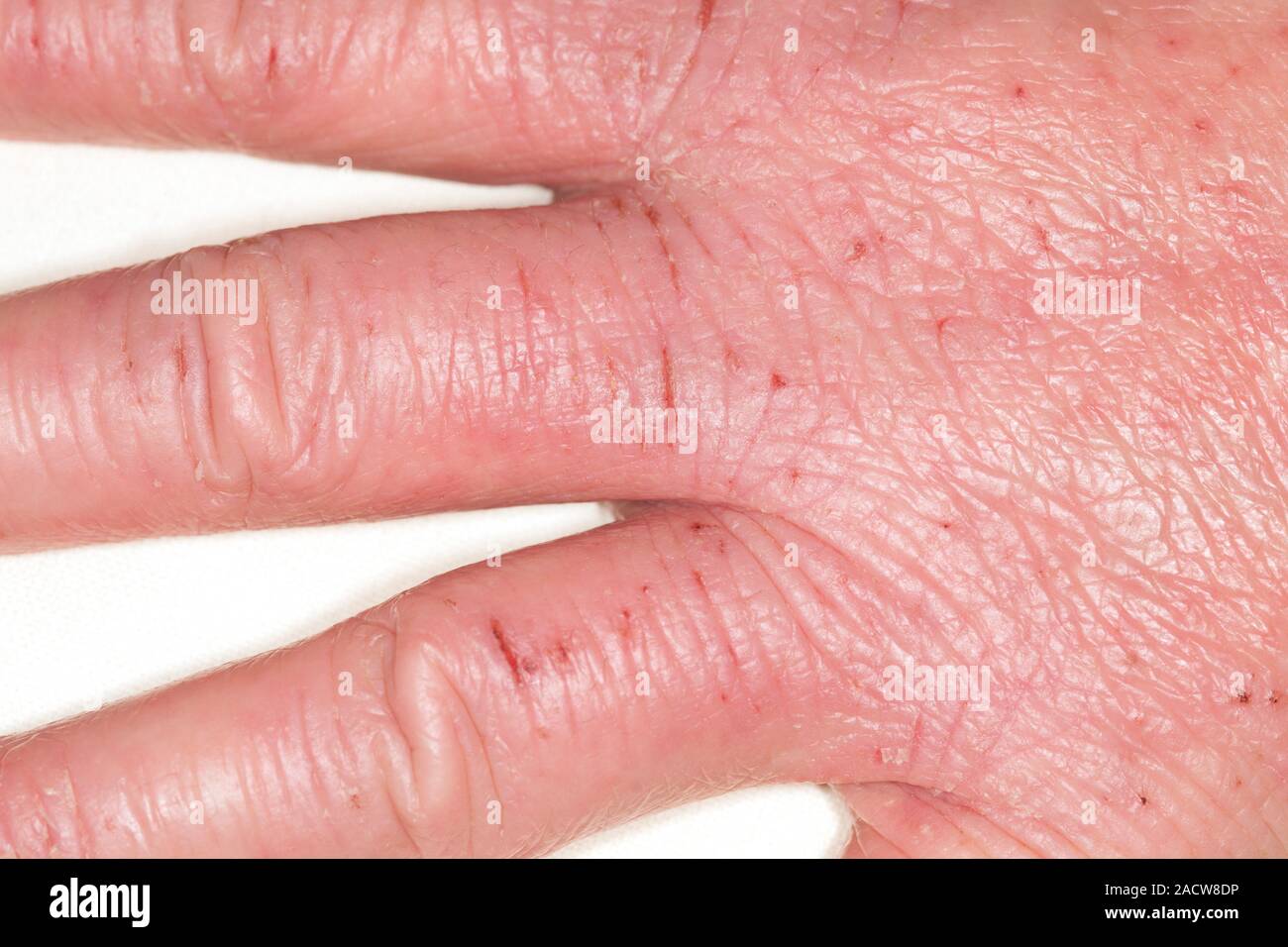 Eczema of the hand. Close-up of eczema on the hand of a 39-year-old female patient. Eczema is an ...