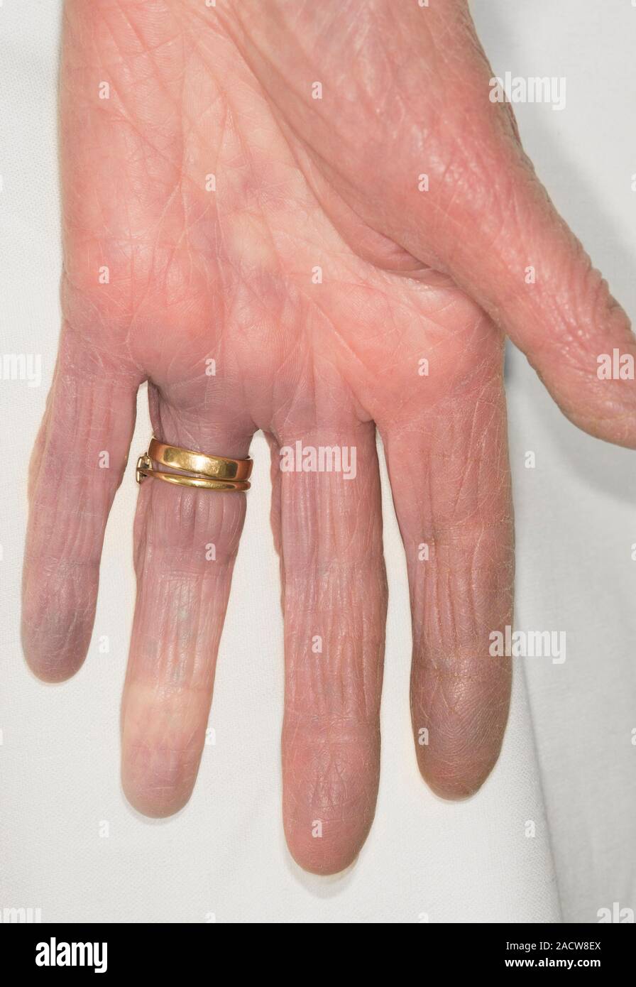 Vasospasm in Raynaud's phenomenon. Close-up of the hand of a 74-year ...
