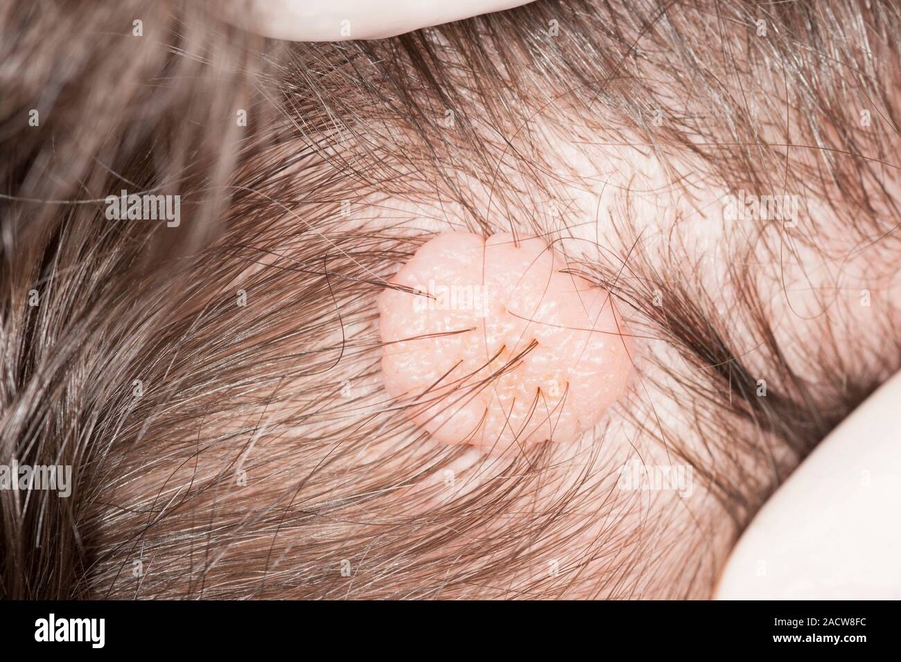 Melanocytic Naevus Mole Of The Scalp Close Up Of A Mole Naevus On The Scalp Of A 56 Year
