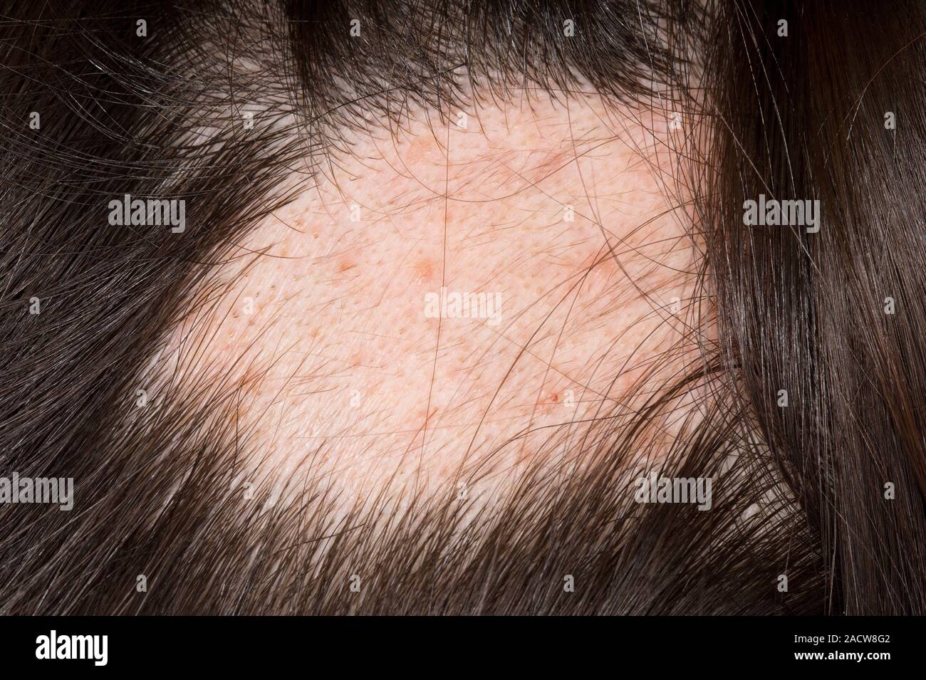 Hair loss. Close-up of the scalp of a 27-year-old female patient with ...