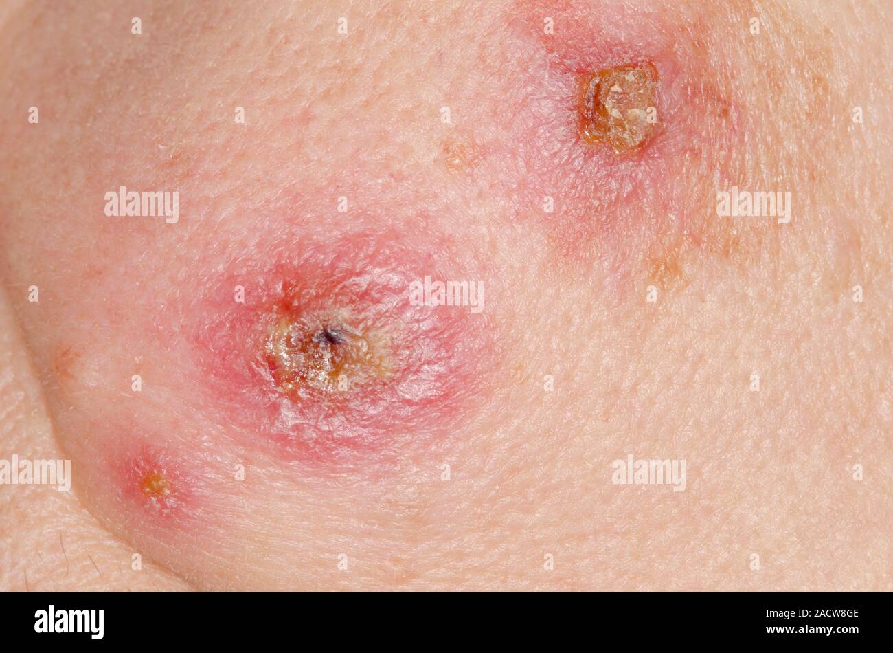 Grover S Disease Grover's Disease | Stock Image Science Source