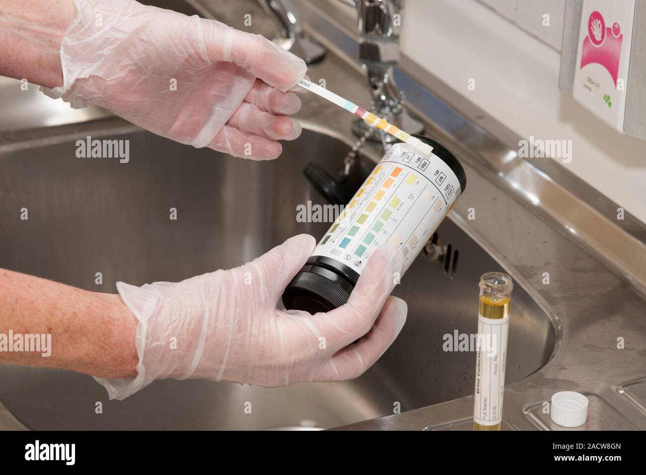 Dipstick test for ketonuria. Medical professional using a dipstick and ...