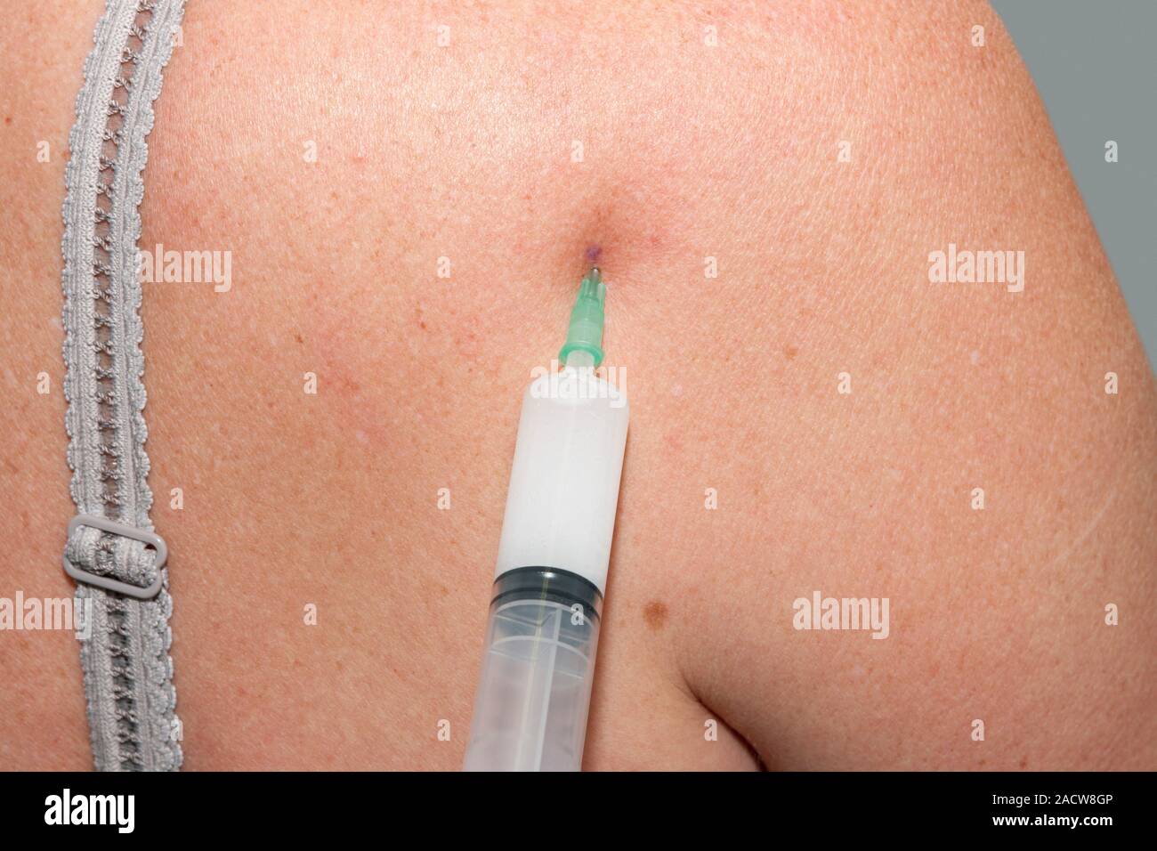 Steroid injection. Close-up of Depo-Medrone and lidocaine being ...