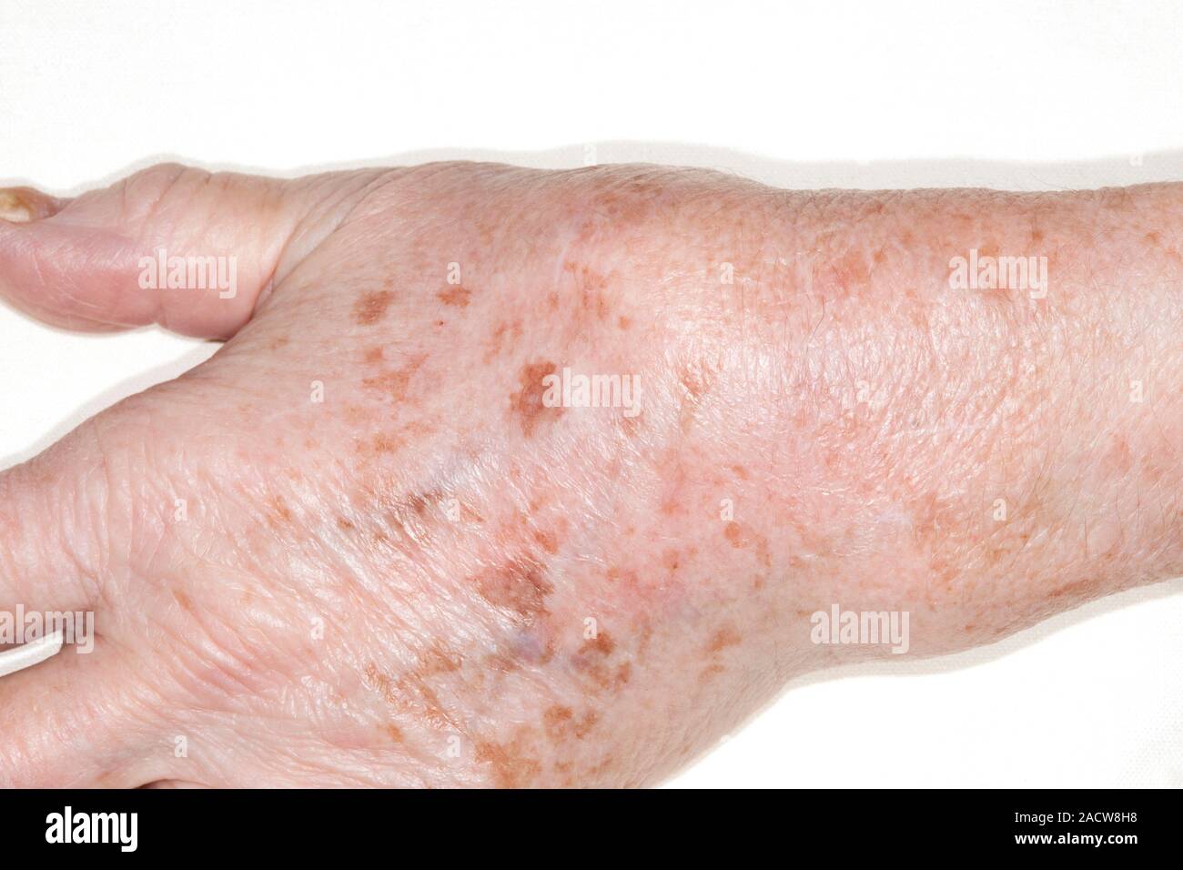 Gout. Close-up of gout affecting the left hand of an 83-year-old female ...
