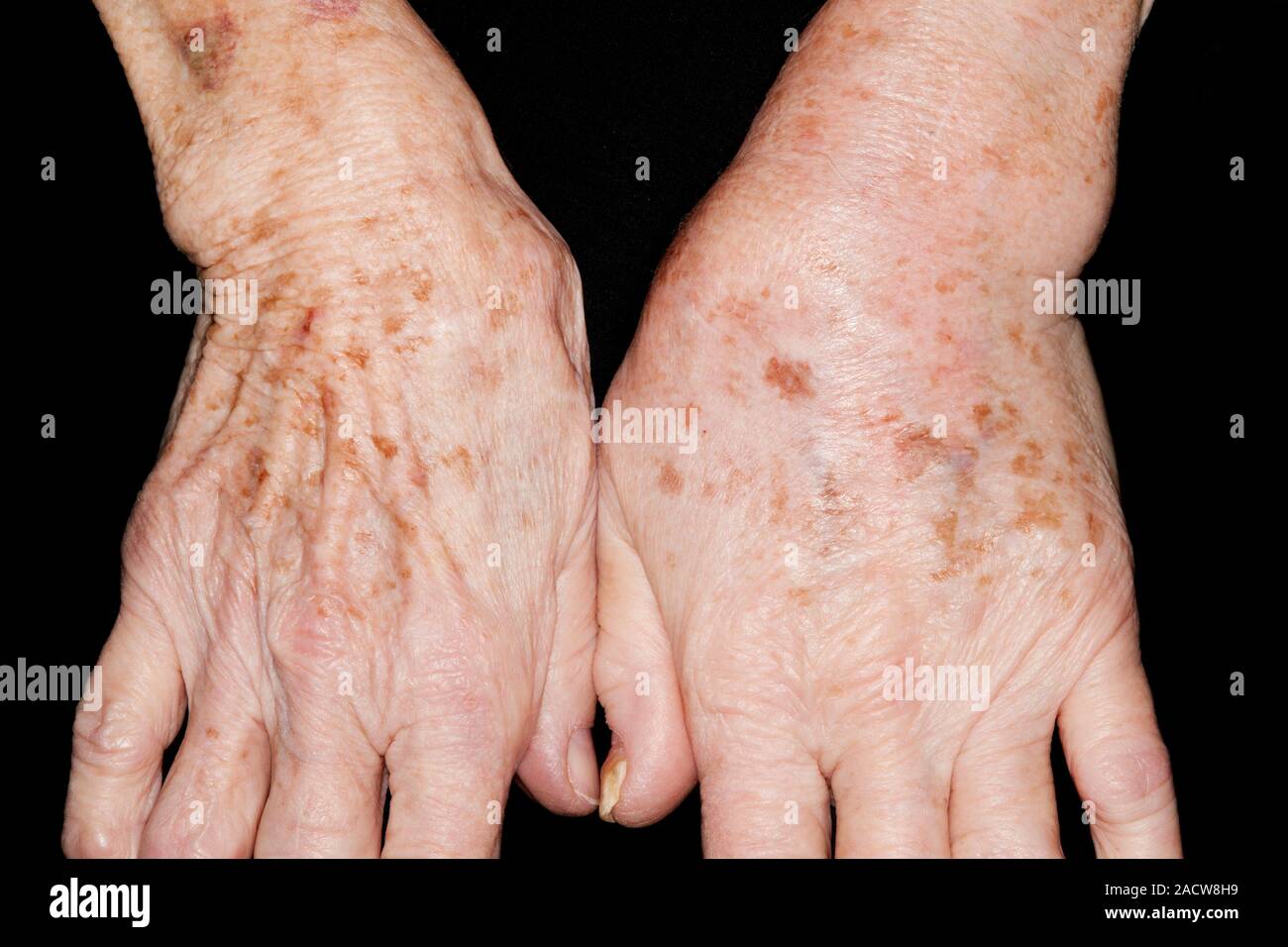 Gout. Close-up comparing the hands of an 83-year-old female patient ...