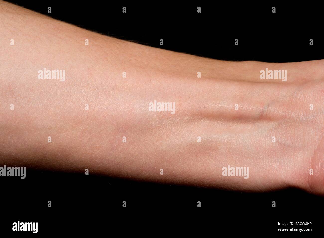 Tendonitis of the wrist. Close-up of the forearm and wrist of an 18 ...