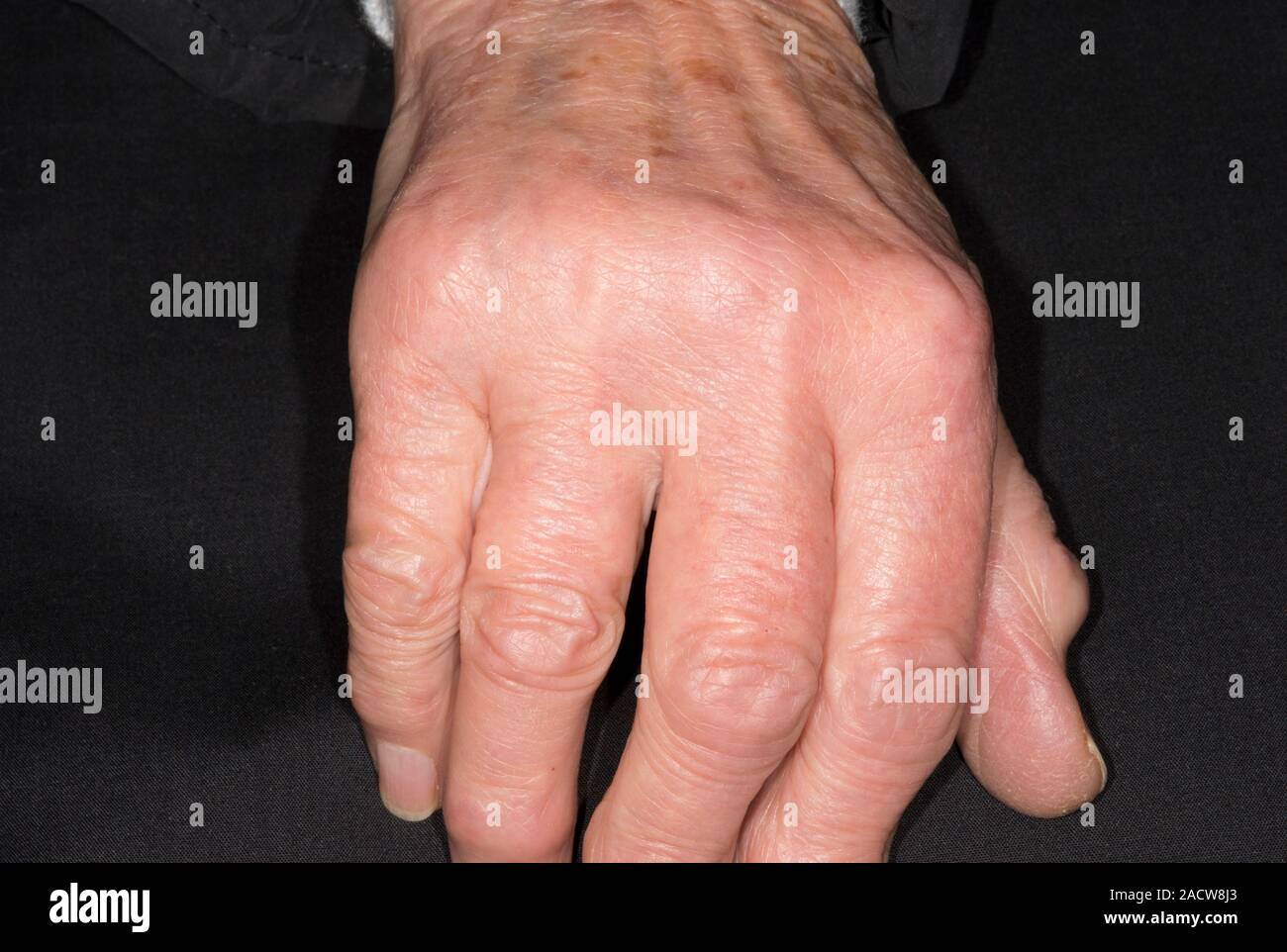 Osteoarthritis of the hand. Close-up of the hand of a 68-year-old male ...
