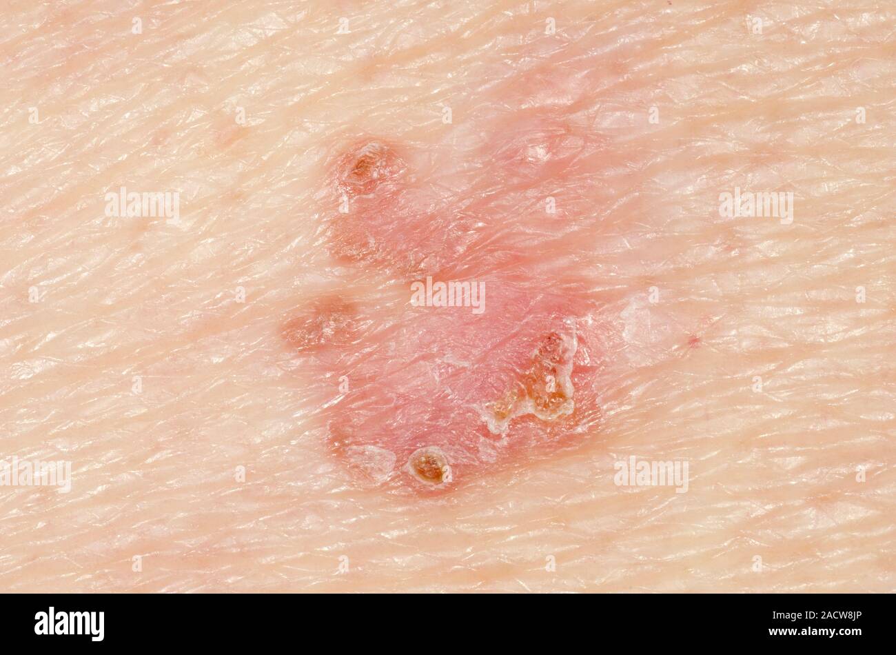 Skin cancer. Close-up of a superficial spreading basal cell carcinoma ...