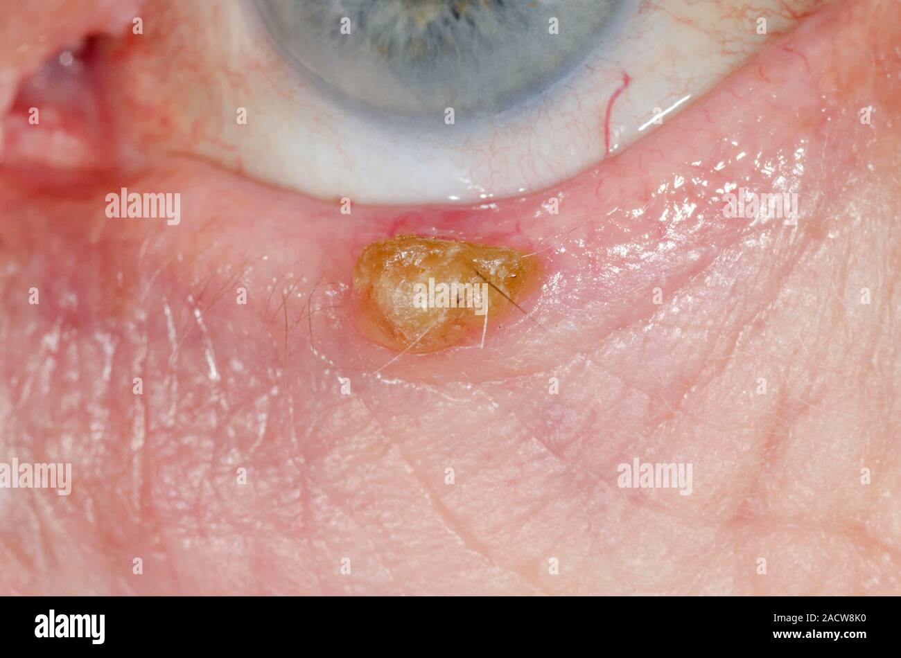 Skin cancer. Close-up of a basal cell carcinoma (BCC) on the lower ...