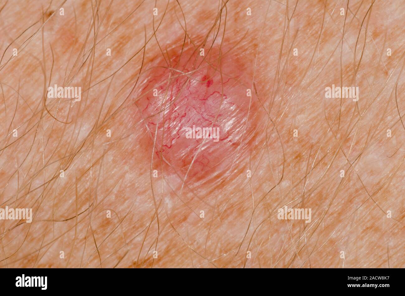 Skin cancer. Close-up of a nodular basal cell carcinoma (BCC) on the ...