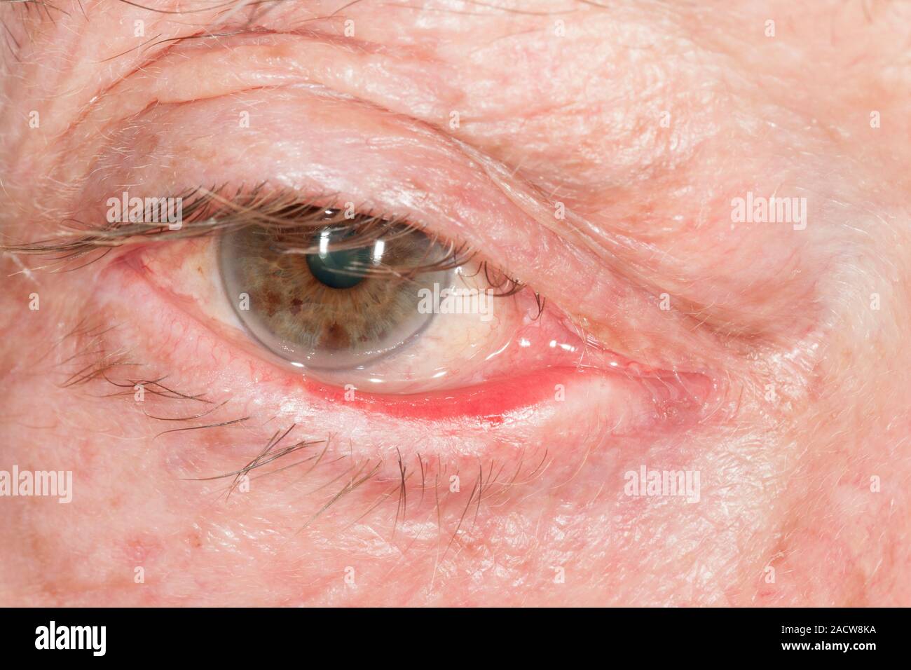 Ectropion. Close-up of a drooping eyelid (ectropion) in an 84-year-old ...