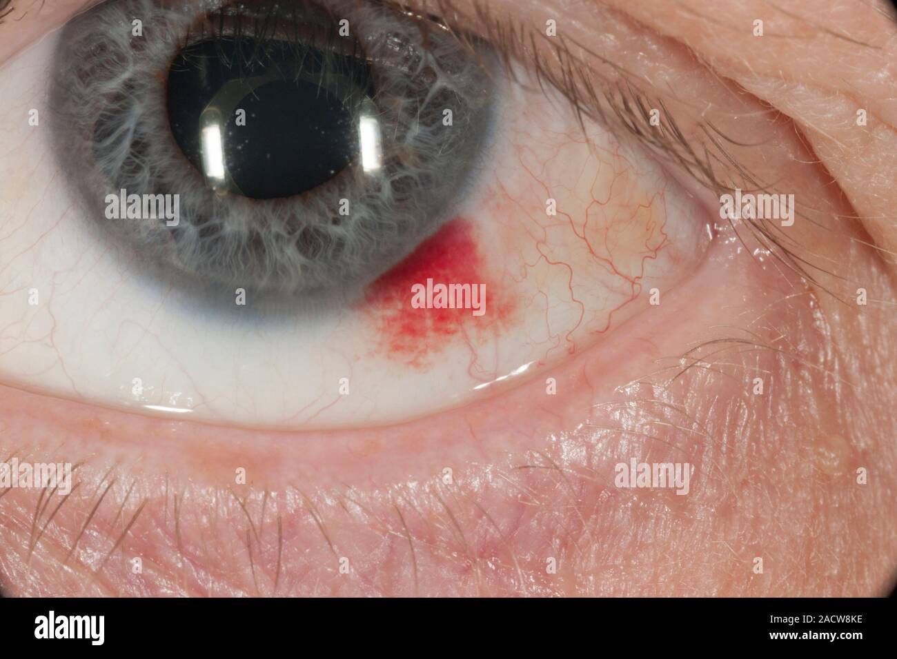Subconjunctival haemorrhage. Close-up of bleeding in the eye of a 50 ...