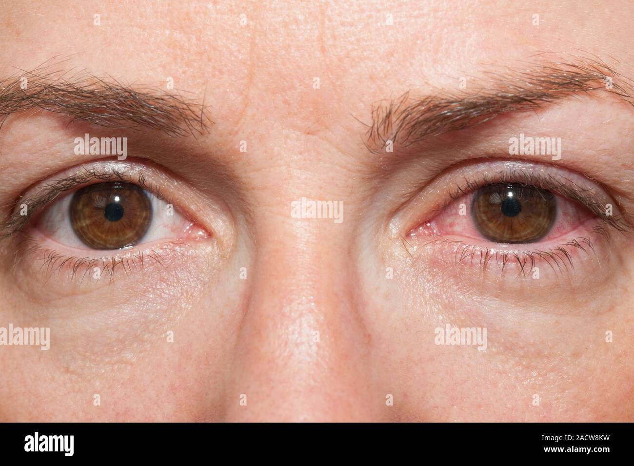 Red eye from contact lenses. Close-up of the eyes of a 34-year-old ...