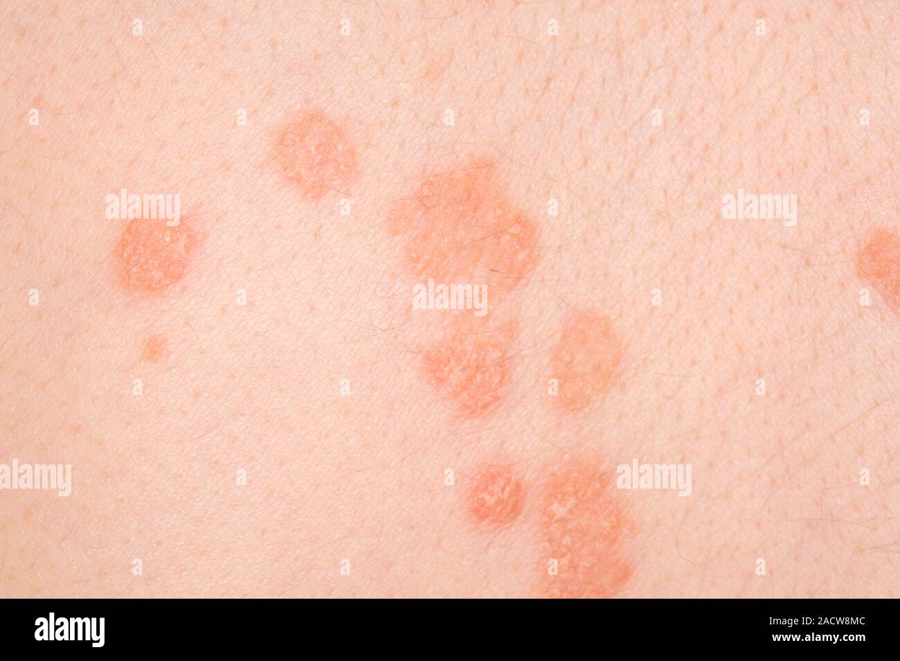 Psoriasis. Close-up of acute guttate psoriasis on the skin of a 10-year ...