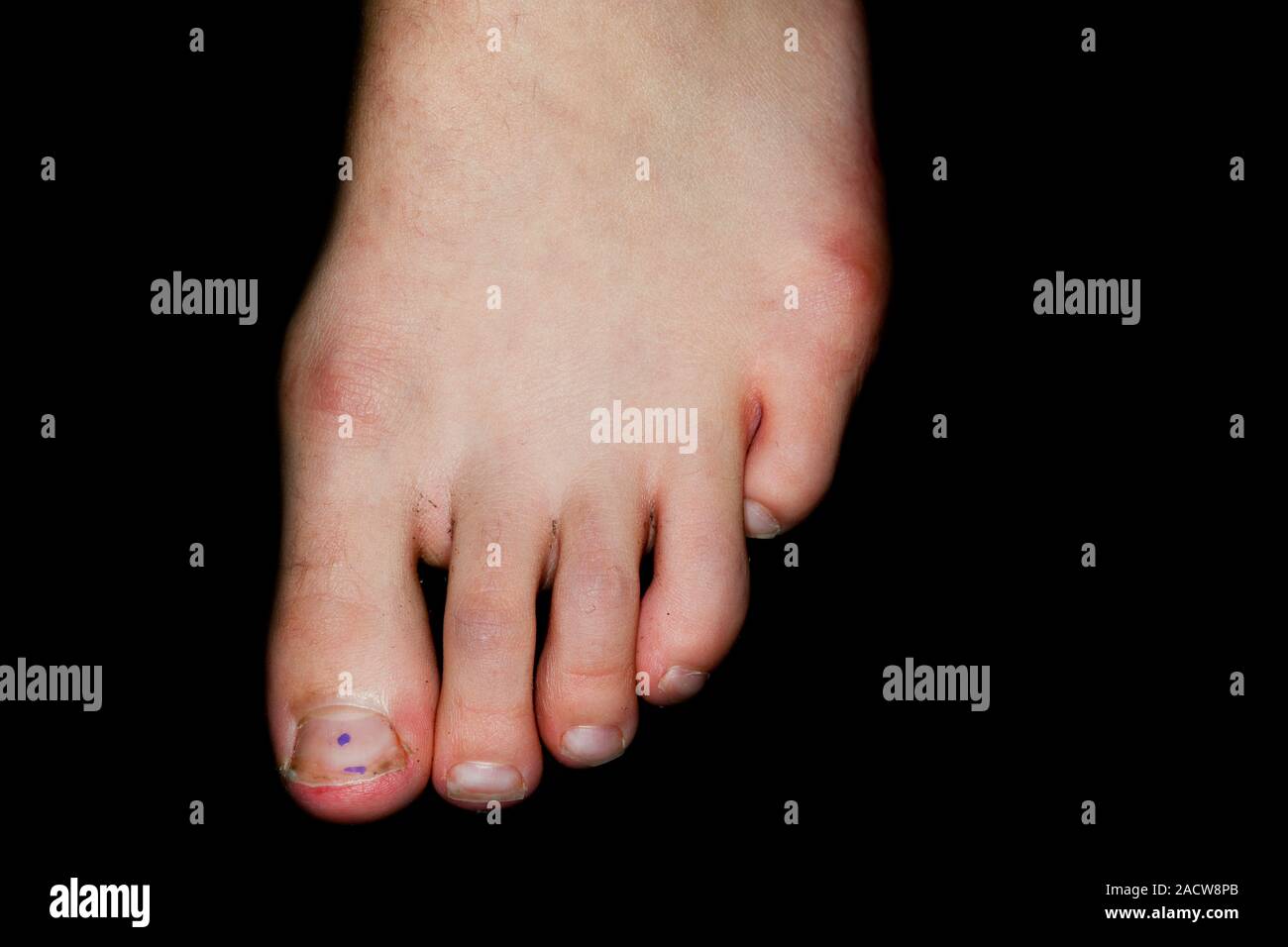 Abnormal little toe. Close-up of the foot of a 10-year-old female ...