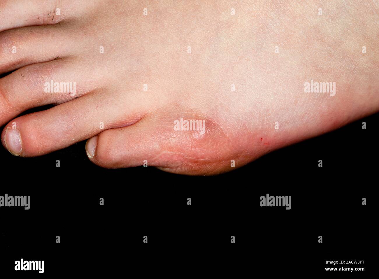 Abnormal little toe. Close-up of the foot of a 10-year-old female ...