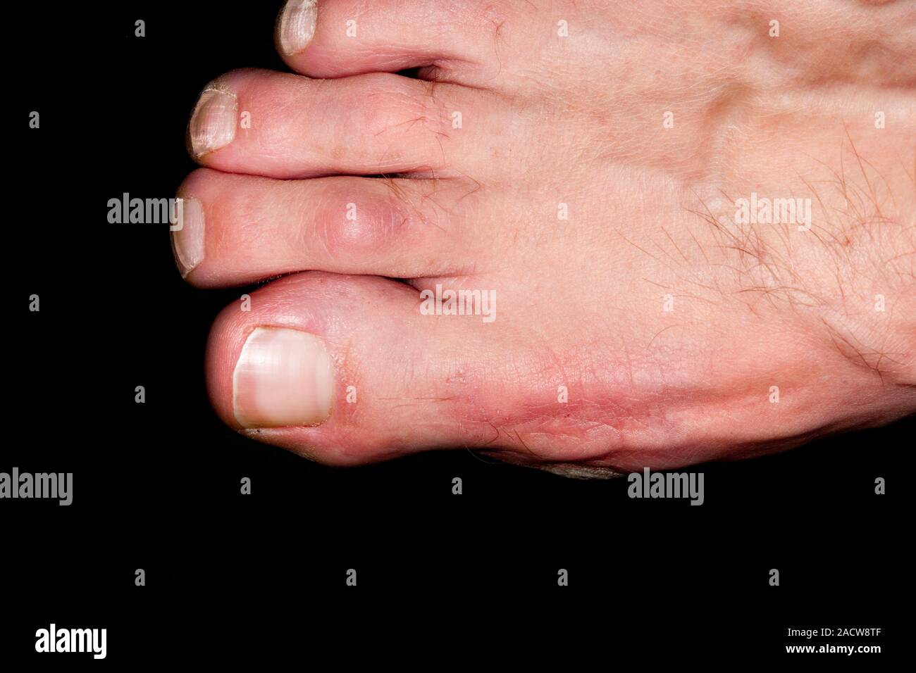 Rotated big toe after bunion surgery. Close-up of the foot of a 52-year ...
