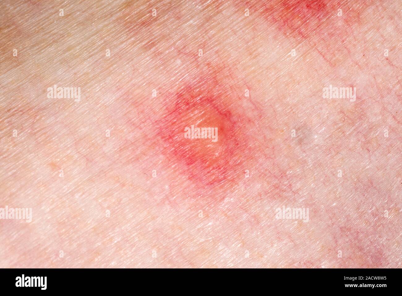 Chicken pox. Close-up of chicken pox rash on the skin of an 85-year-old ...