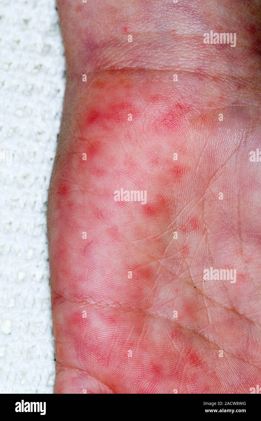 Hand foot and mouth disease. Close-up of a rash on the hand of a 6-year ...