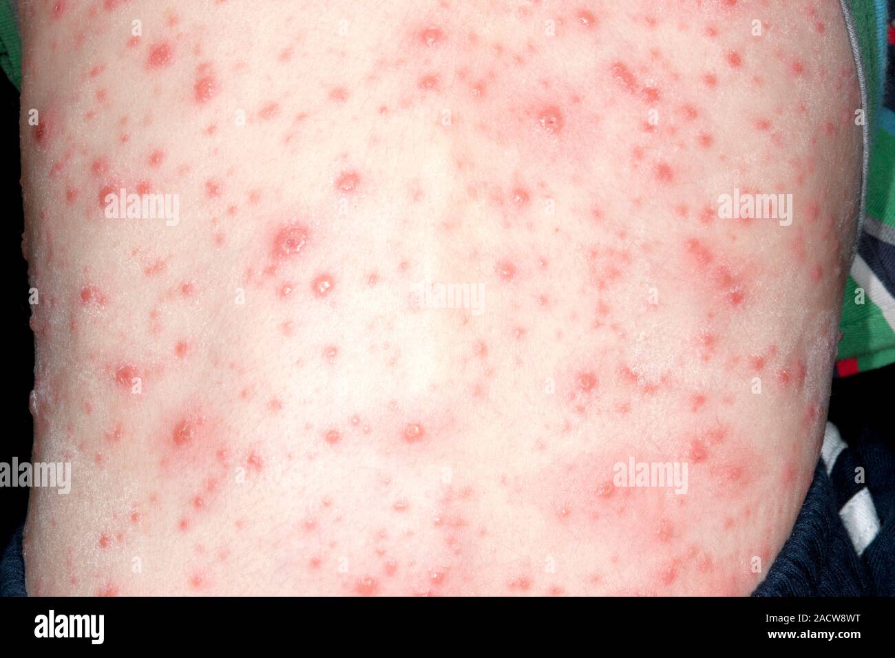Chicken pox. Close-up of chicken pox rash on the skin of a 3-year-old ...