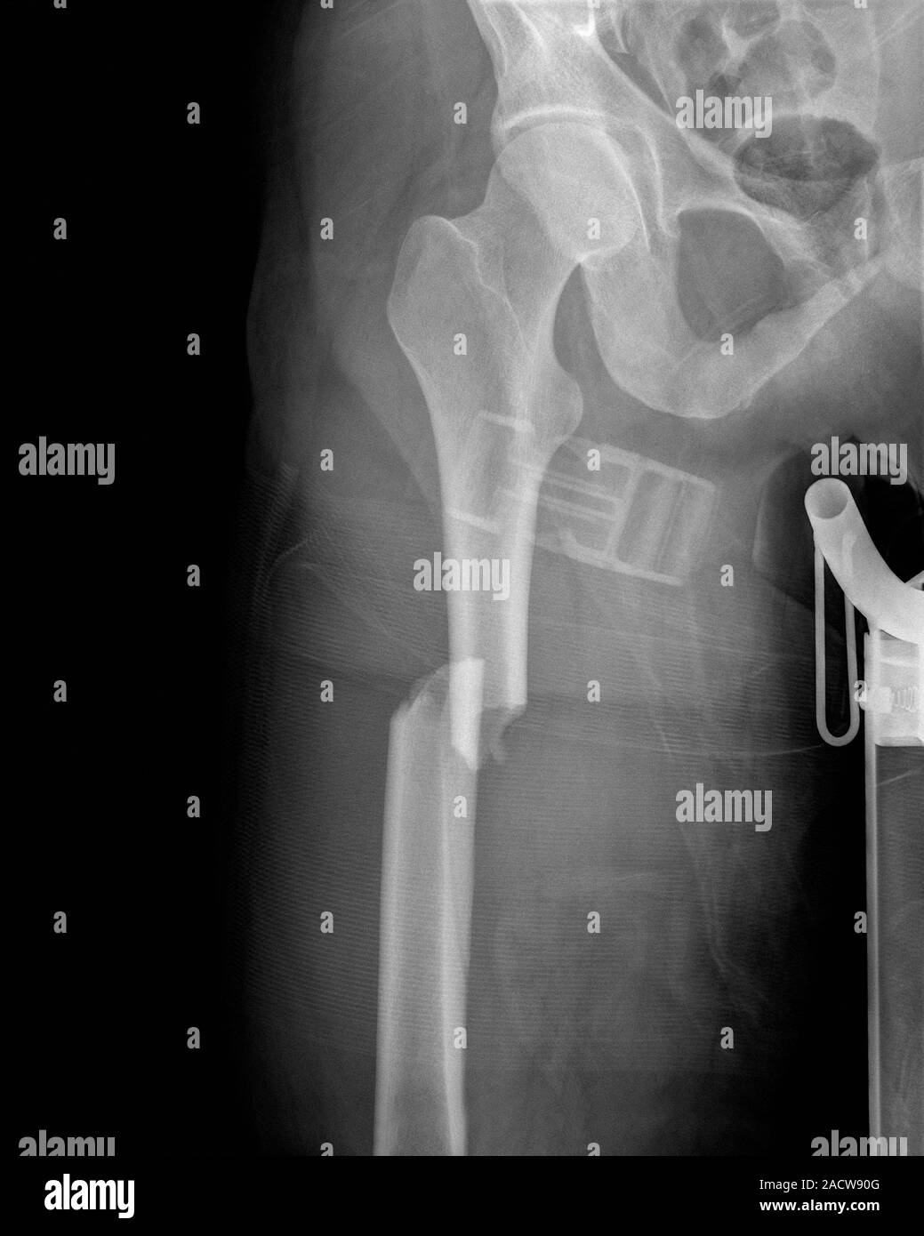 Broken femur. X-ray of the fractured shaft of a femur (thigh bone) in a ...