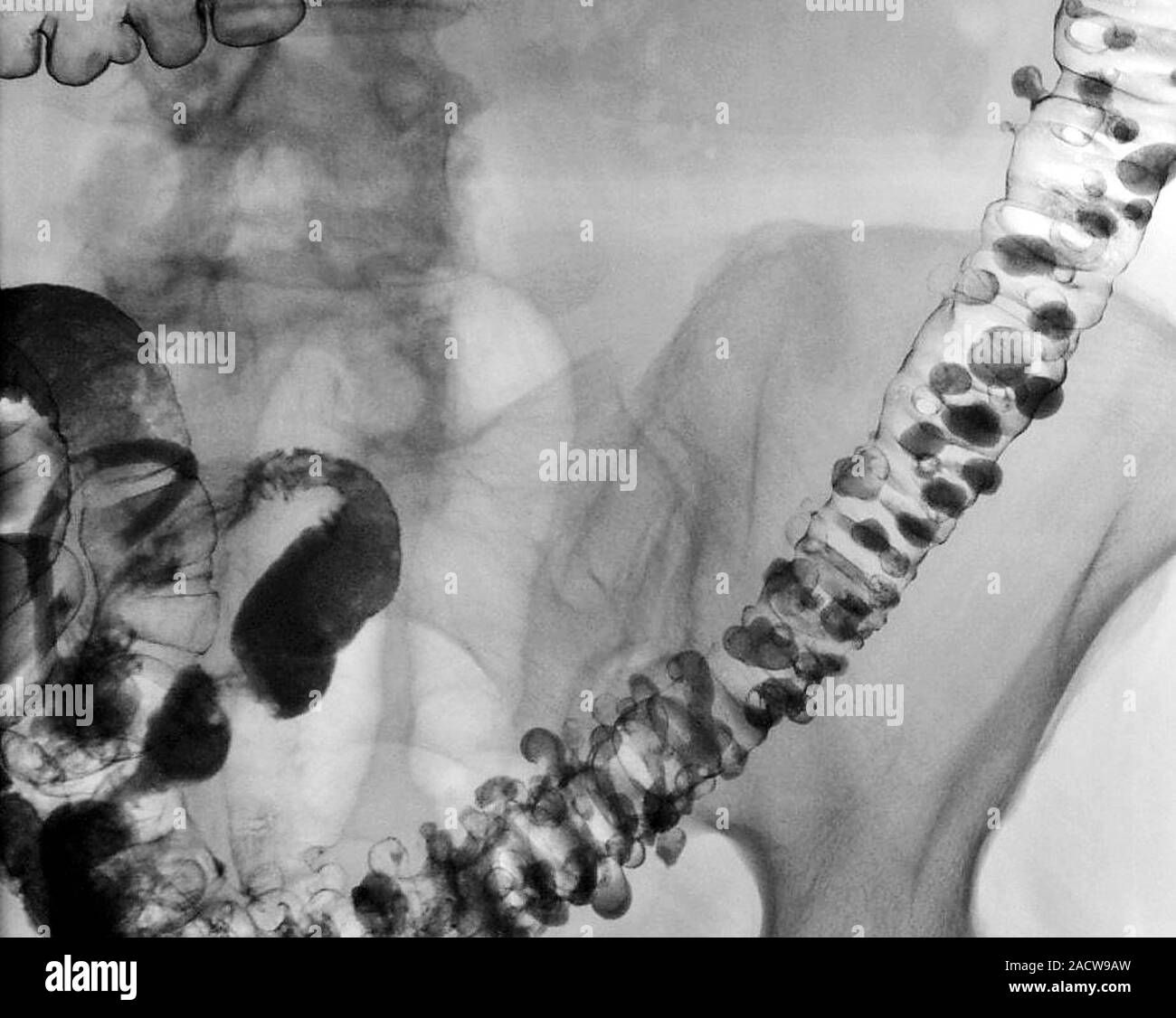 Diverticulitis of the sigmoid colon, X-ray. The dark patches are ...
