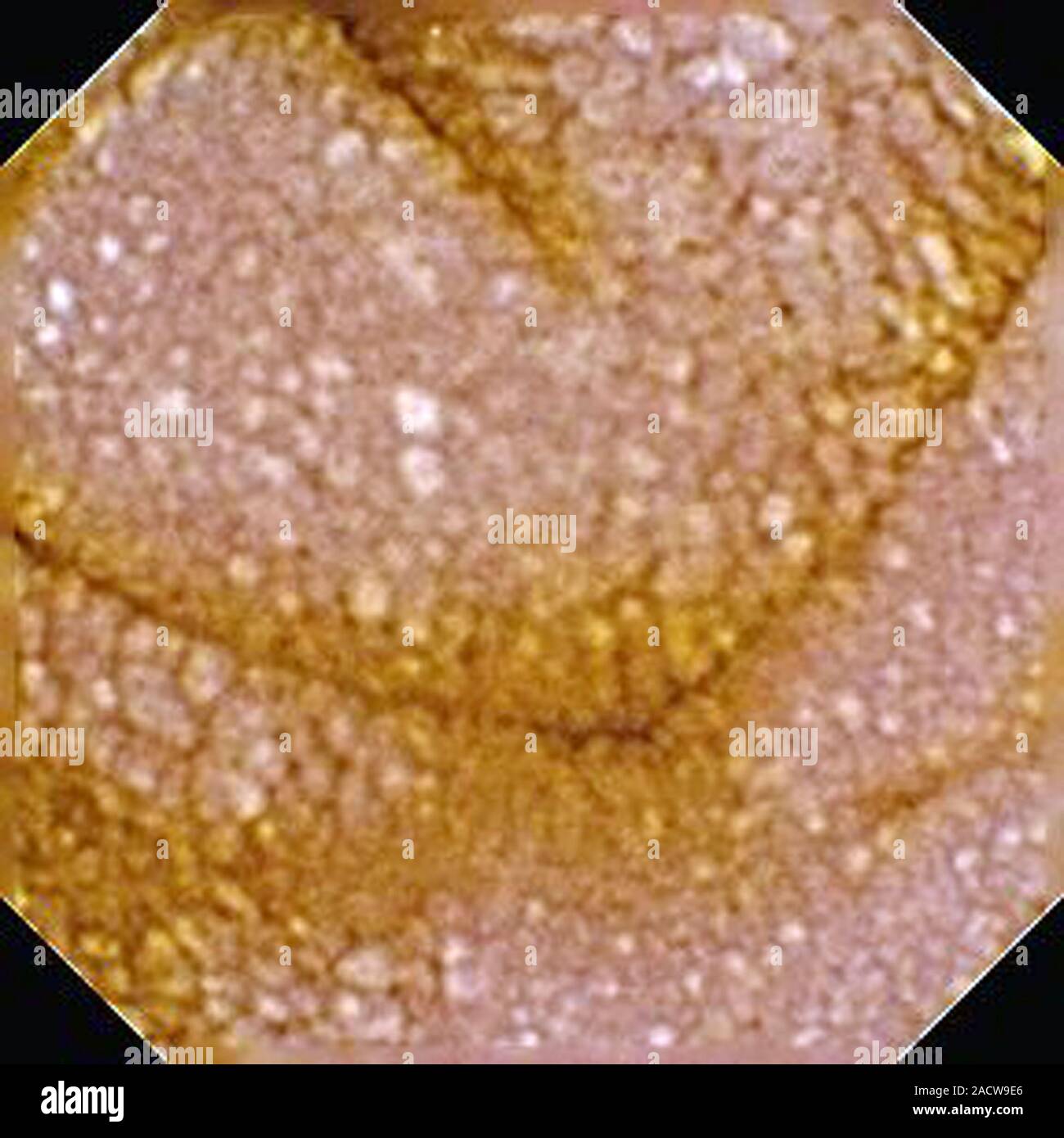 Whipple's disease, pill camera view. Duodenal mucosa in Whipple's ...