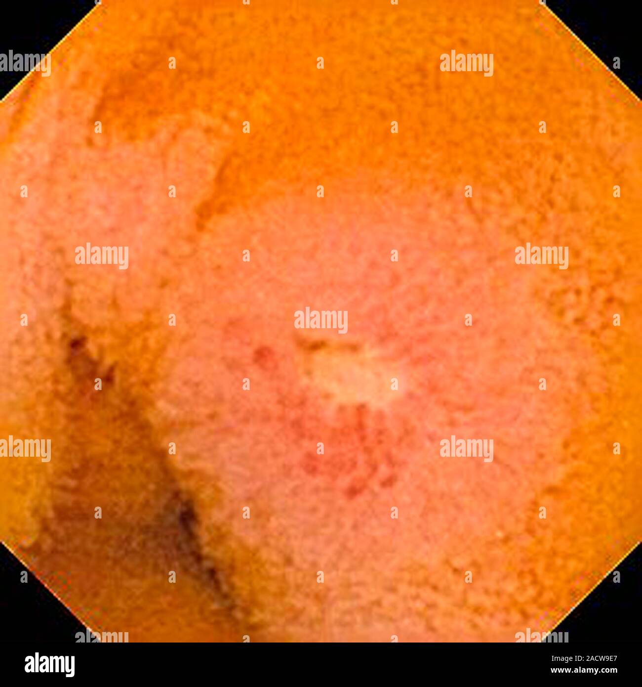Crohn's disease ulcer, pill camera view. Small ulcerations caused by ...