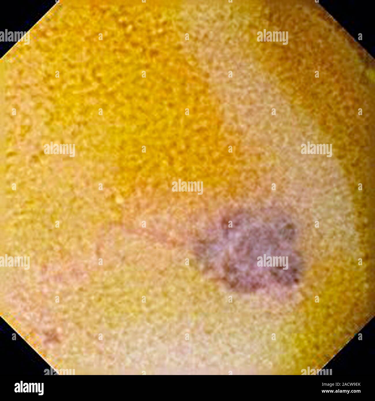 Venectasias, pill camera view. Clinically insignificant venectasia ...