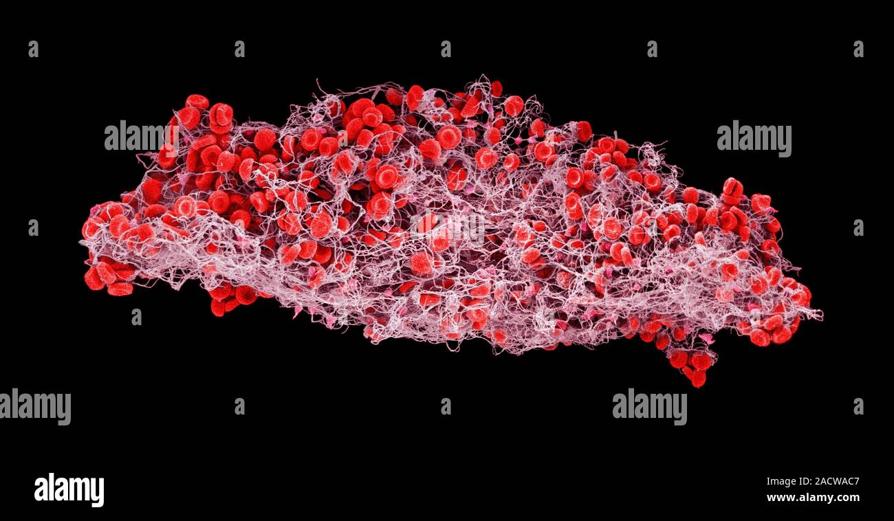 Blood clot, coloured scanning electron micrograph (SEM). Red blood ...
