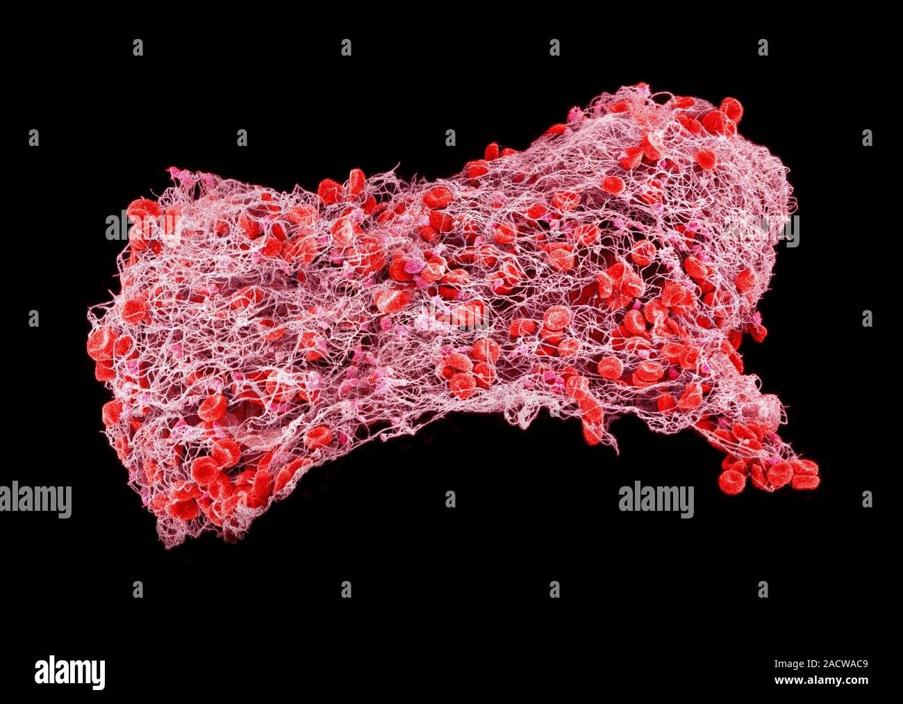 Blood clot, coloured scanning electron micrograph (SEM). Red blood ...
