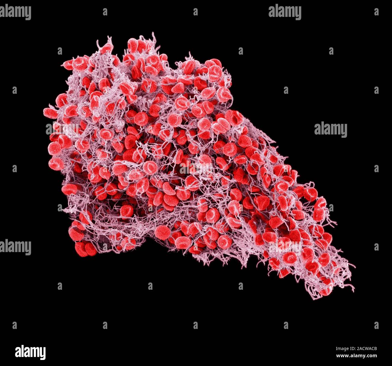 Blood clot, coloured scanning electron micrograph (SEM). Red blood ...