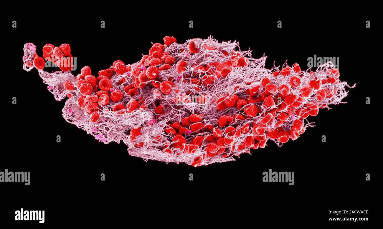 Blood clot, coloured scanning electron micrograph (SEM). Red blood ...