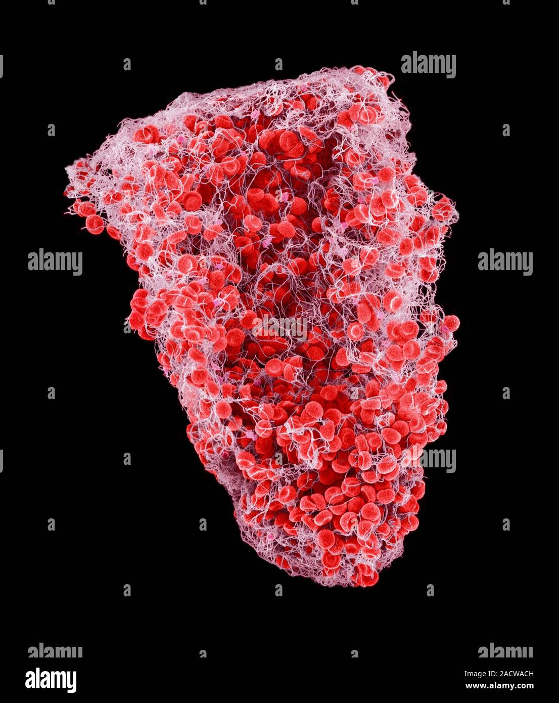 Blood clot, coloured scanning electron micrograph (SEM). Red blood ...