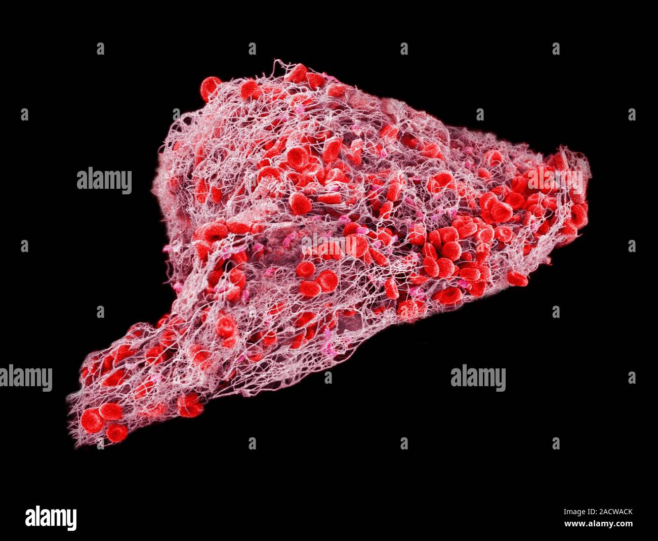 Blood clot, coloured scanning electron micrograph (SEM). Red blood ...