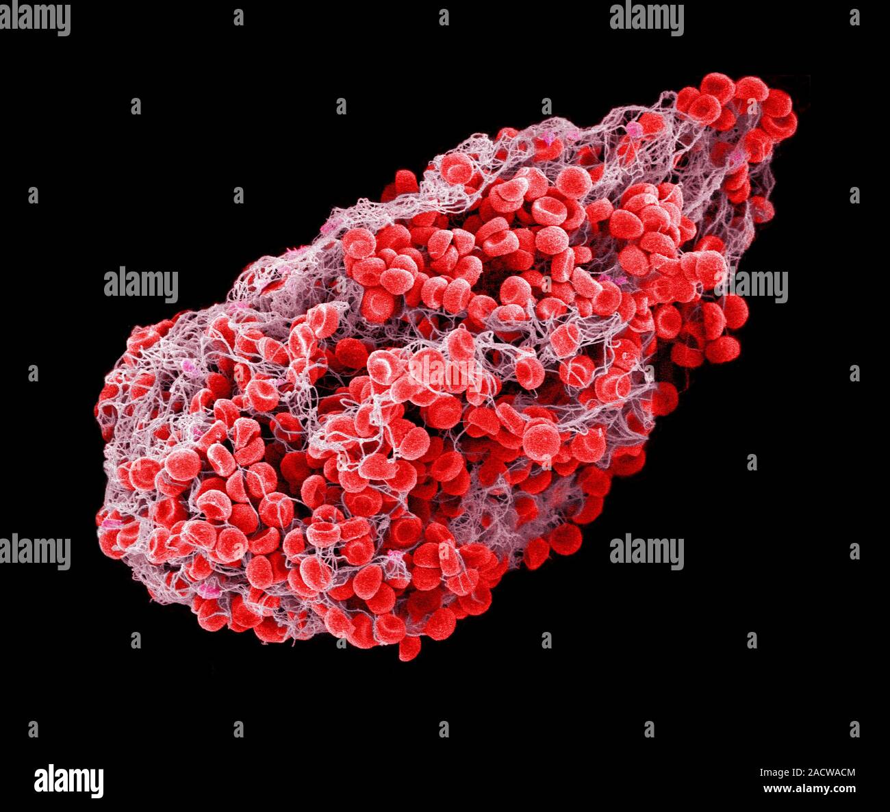 Blood clot, coloured scanning electron micrograph (SEM). Red blood ...