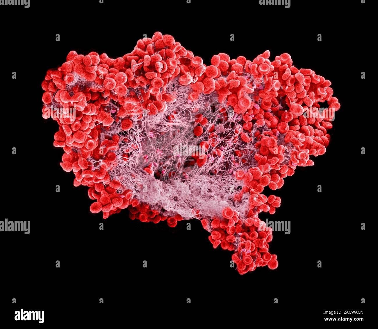 Blood clot, coloured scanning electron micrograph (SEM). Red blood ...