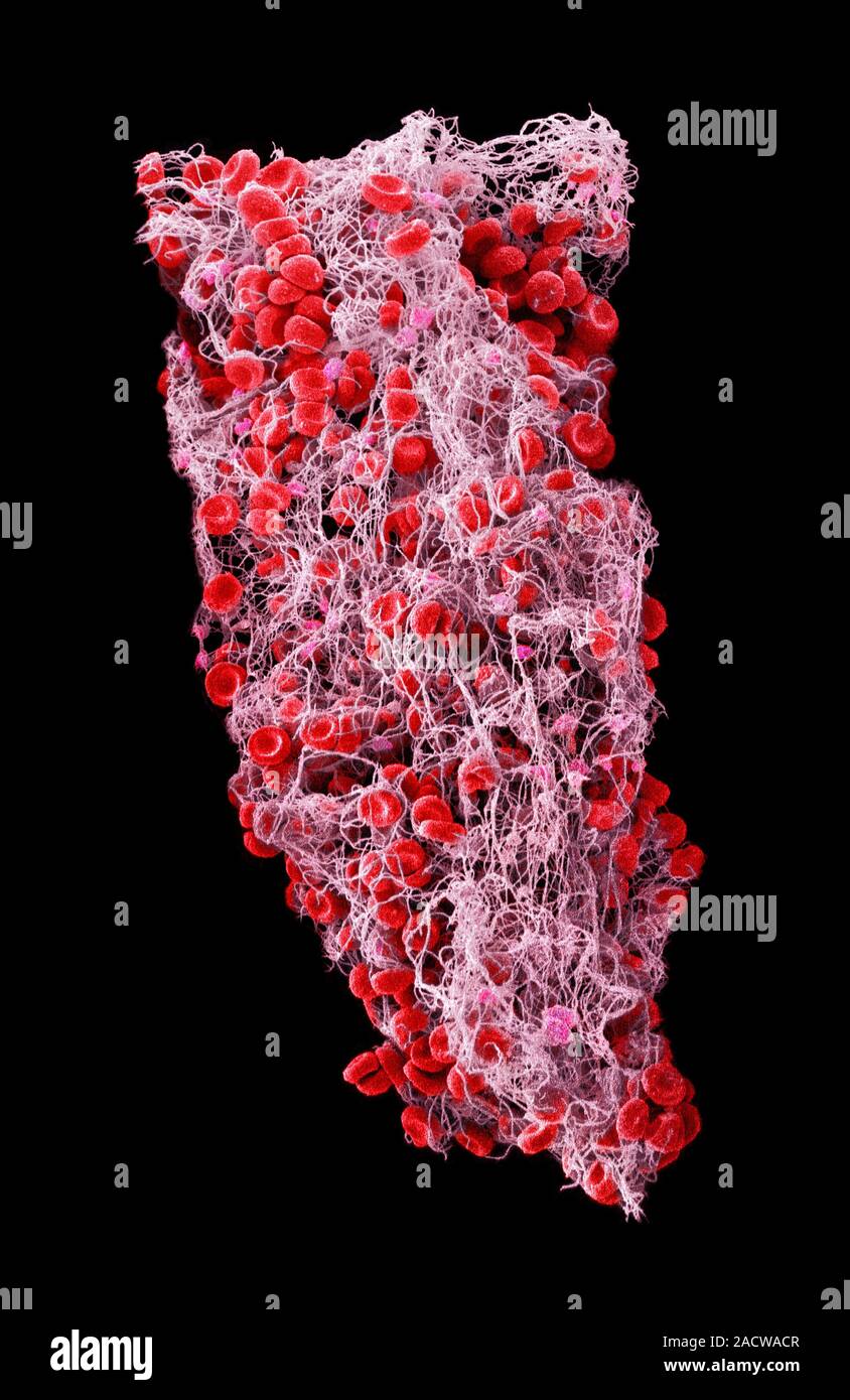 Blood clot, coloured scanning electron micrograph (SEM). Red blood ...