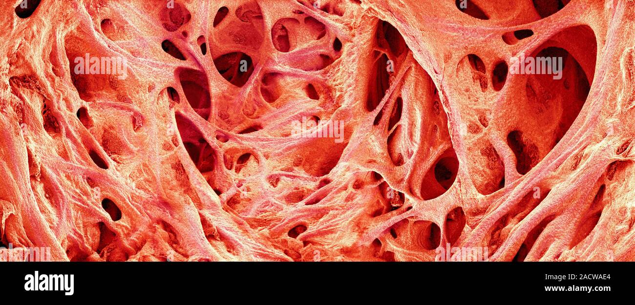 Trabeculae carneae in the left ventricle of the heart, coloured ...