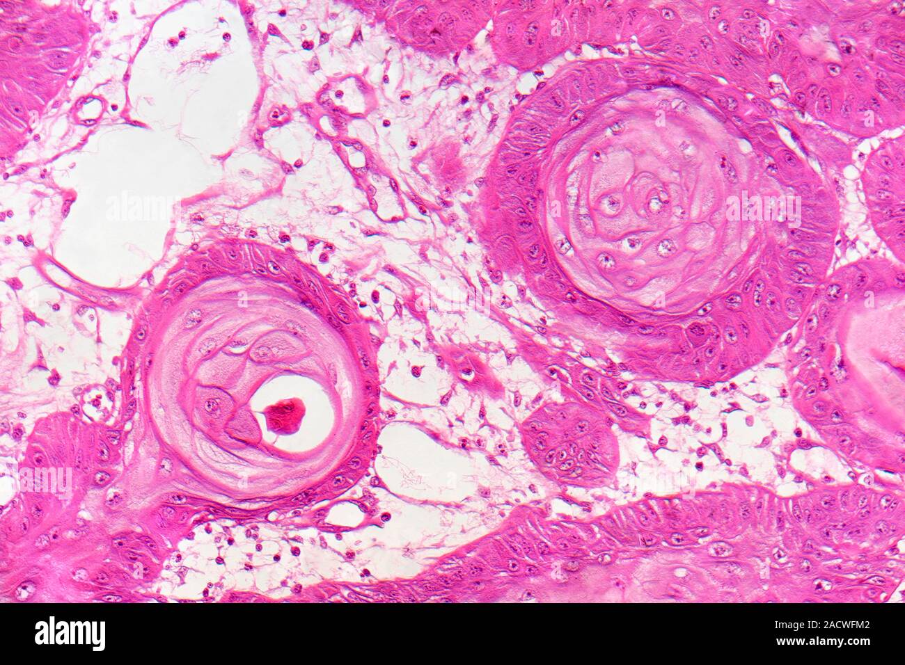 Oesophageal cancer. Light micrograph of an oesophageal cancer biopsy ...
