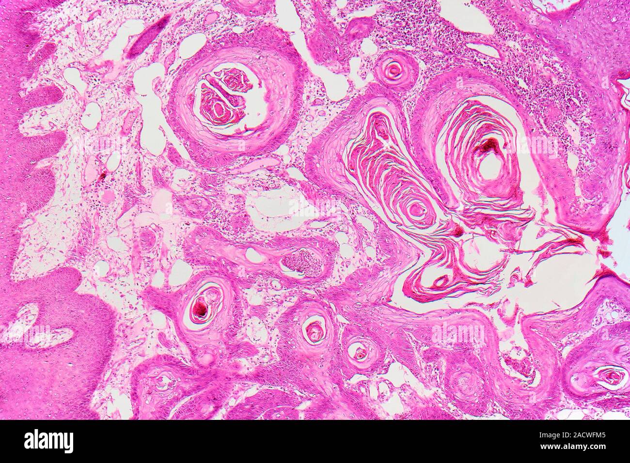 Oesophageal cancer. Light micrograph of an oesophageal cancer biopsy ...