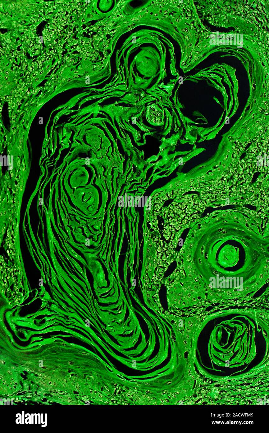 Oesophageal cancer. Light micrograph of an oesophageal cancer biopsy ...