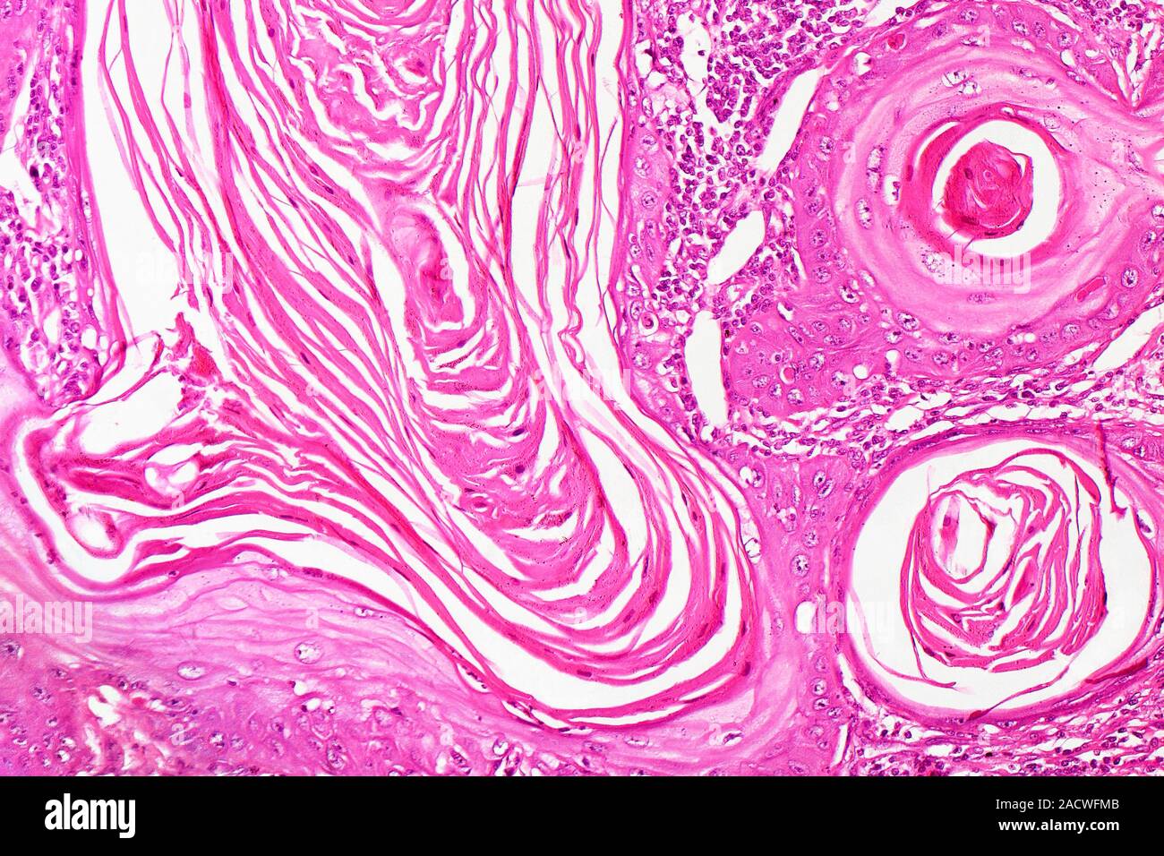 Oesophageal cancer. Light micrograph of an oesophageal cancer biopsy ...