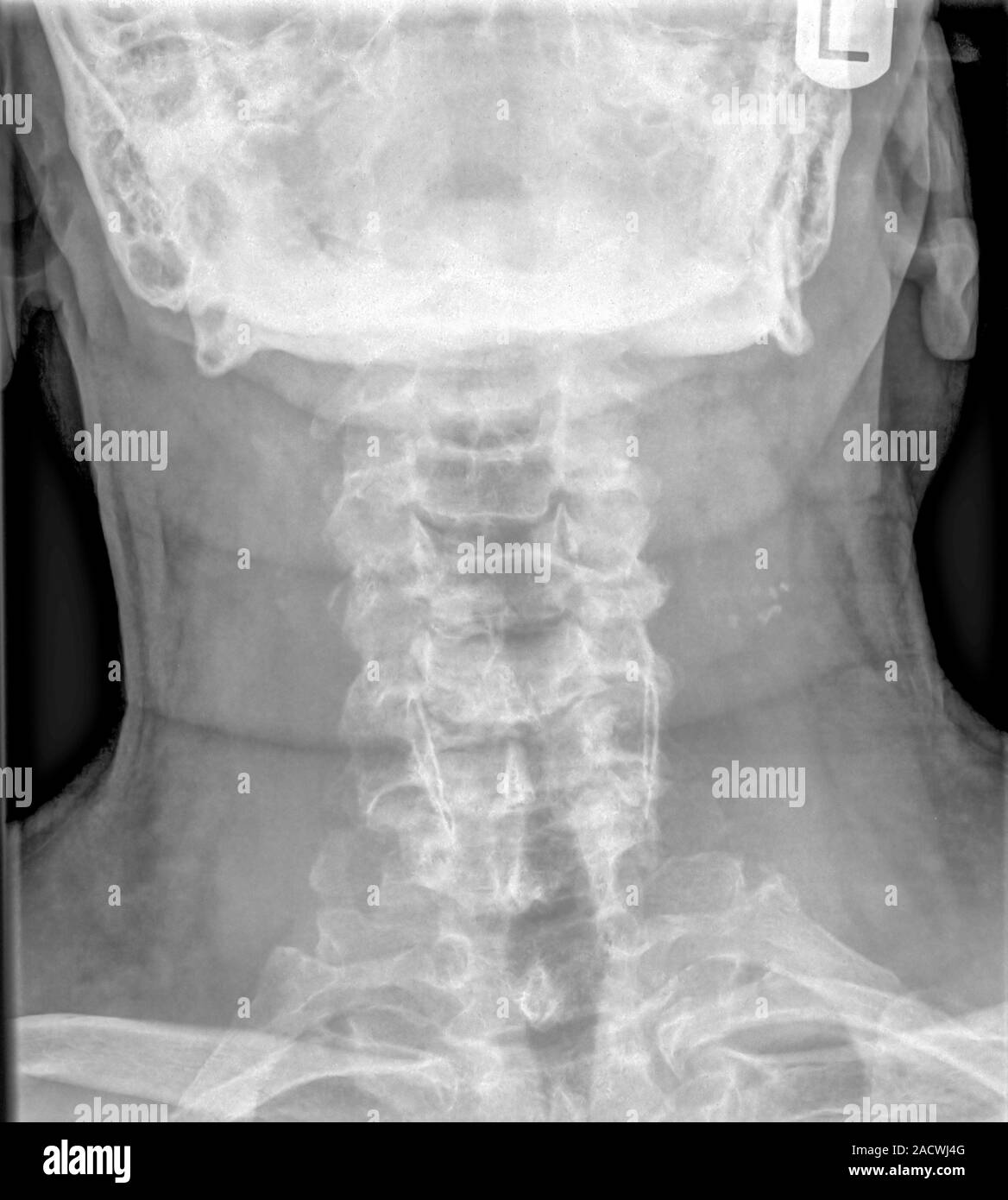 Normal Cervical spine x-ray of a 63 year old male patient back view ...