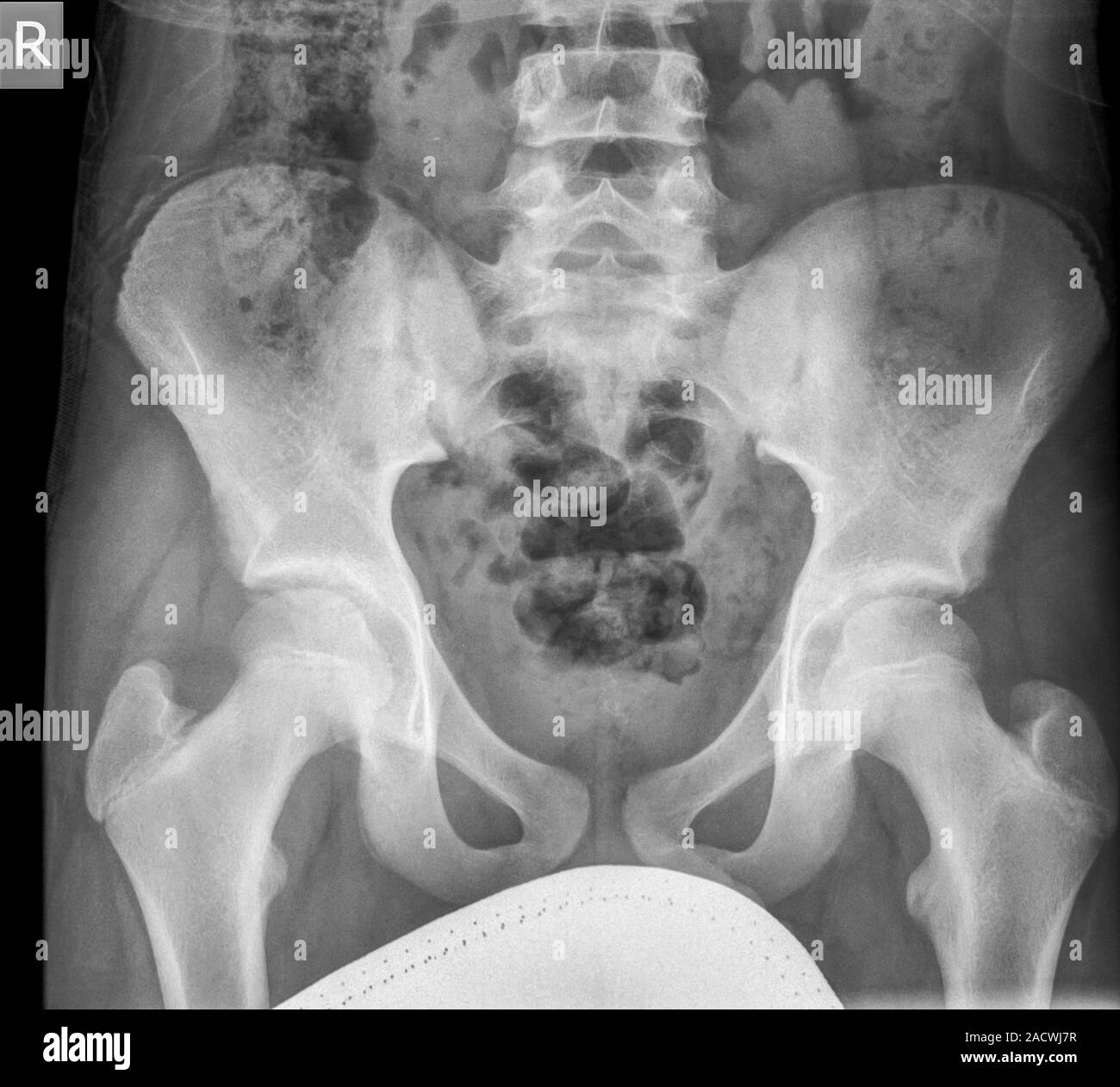 Pelvis x-ray of 13 year old male patient front view Stock Photo - Alamy