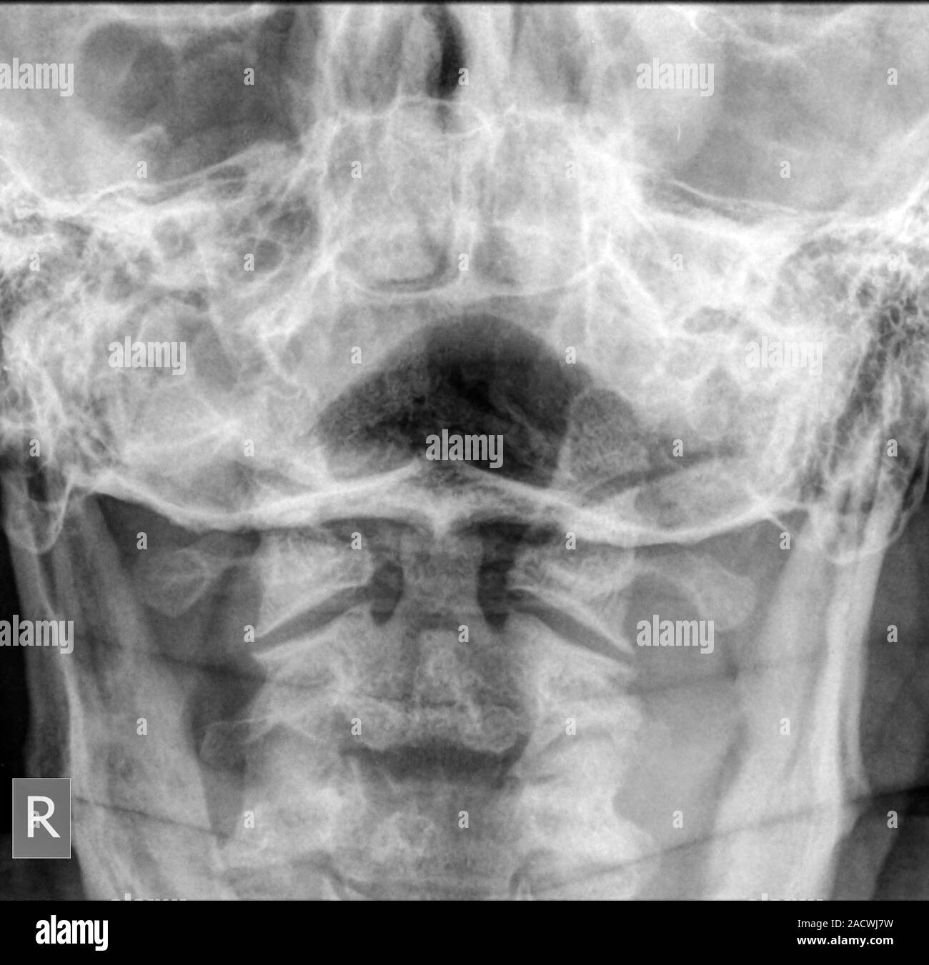 Normal Cervical spine x-ray of a 63 year old male patient front view ...