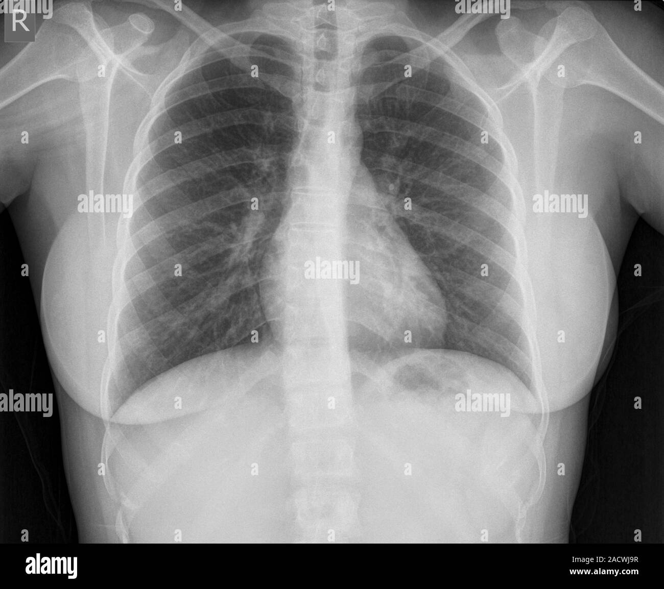 Chest x-ray of a 27 year old female suffering from Bronchitis. front ...